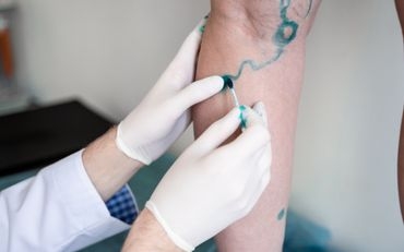 What Is Varix Surgery And How Is It Performed? - Prof. Dr. Öztekin Oto